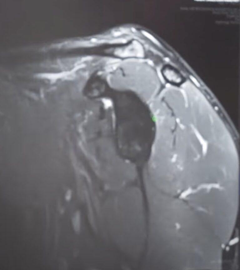 Doctor Reviews CPI Stem Cell Results for Rotator Cuff Injury!